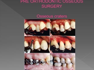PERIO – ORTHO RELATIONSHIP.pptx