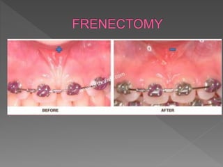 PERIO – ORTHO RELATIONSHIP.pptx