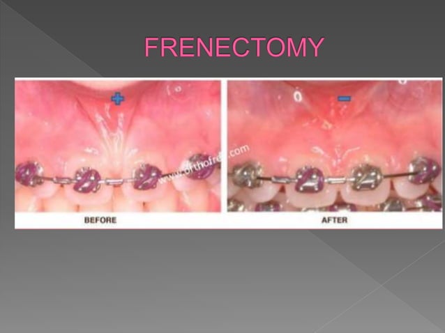 PERIO – ORTHO RELATIONSHIP.pptx | Oral care | Personal Care