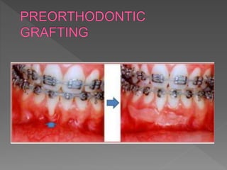 PERIO – ORTHO RELATIONSHIP.pptx
