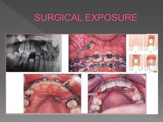 PERIO – ORTHO RELATIONSHIP.pptx | Oral care | Personal Care