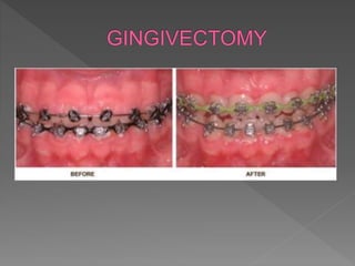 PERIO – ORTHO RELATIONSHIP.pptx