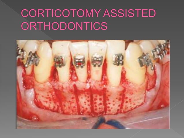 PERIO – ORTHO RELATIONSHIP.pptx | Oral care | Personal Care