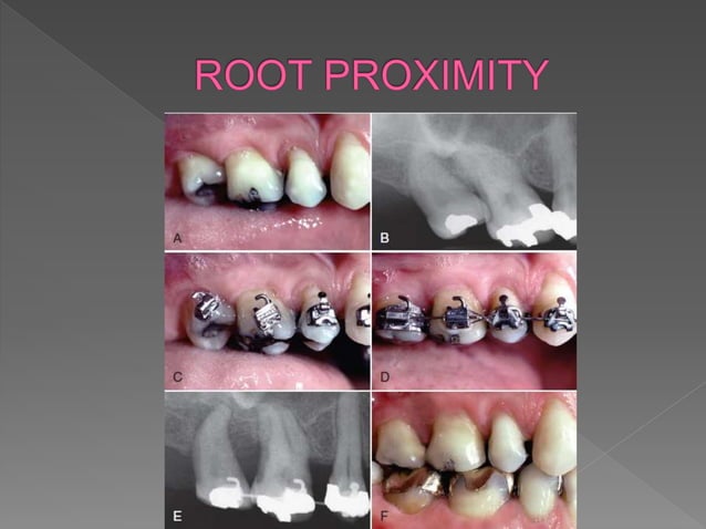 PERIO – ORTHO RELATIONSHIP.pptx | Oral care | Personal Care