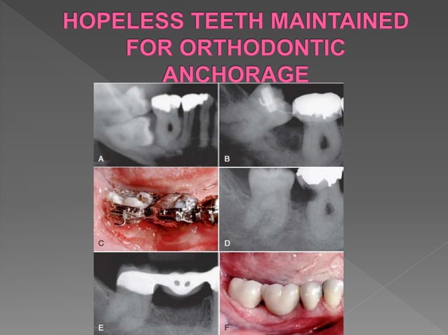 PERIO – ORTHO RELATIONSHIP.pptx | Oral care | Personal Care