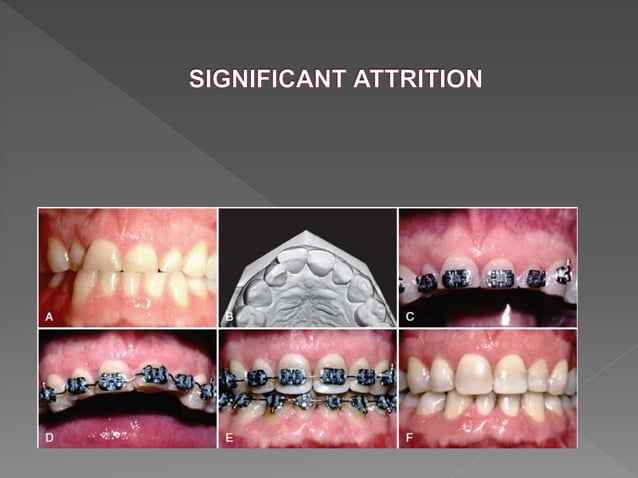 PERIO – ORTHO RELATIONSHIP.pptx | Oral care | Personal Care