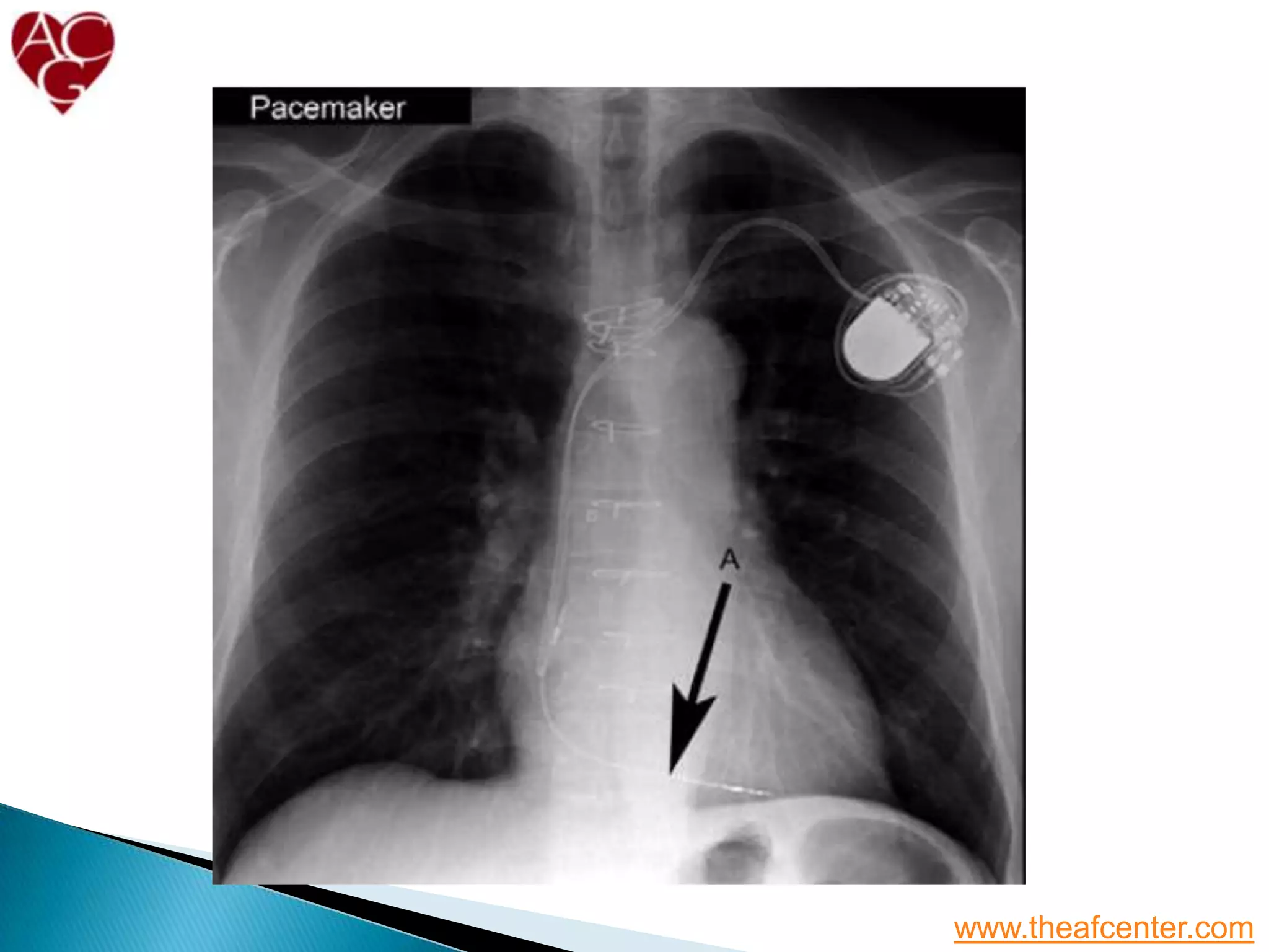 Perioperative cardiac device management | PPTX