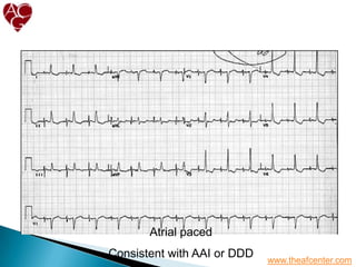 Perioperative cardiac device management | PPTX