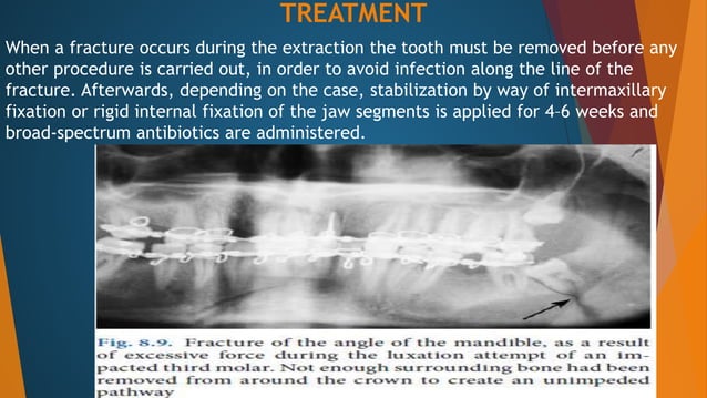 complication of extraction | PPTX