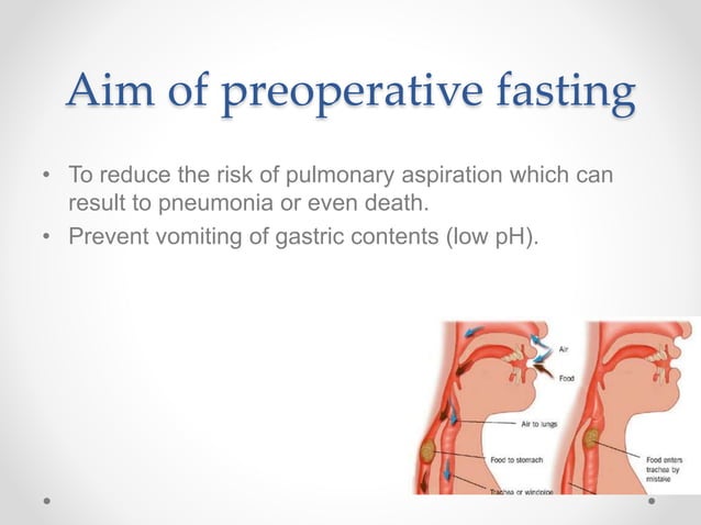 Perioperative Fasting.pptx