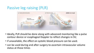 Perioperative fluid therapy for major surgery | PPSX