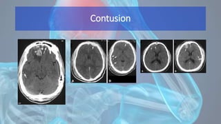 Perioperative management of Traumatic Brain Injury.pptx