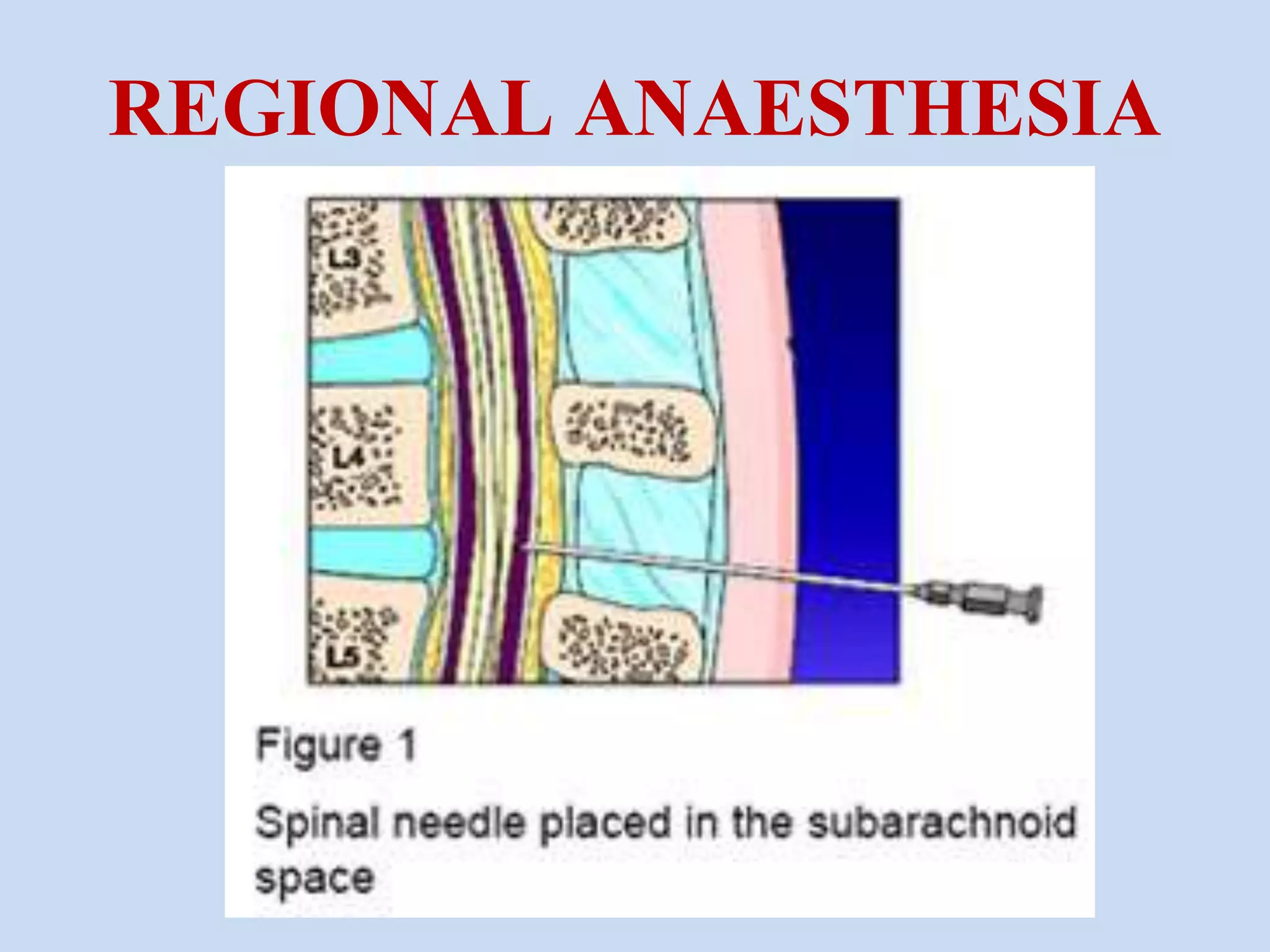 anesthesia- types of anaesthesia | PPTX