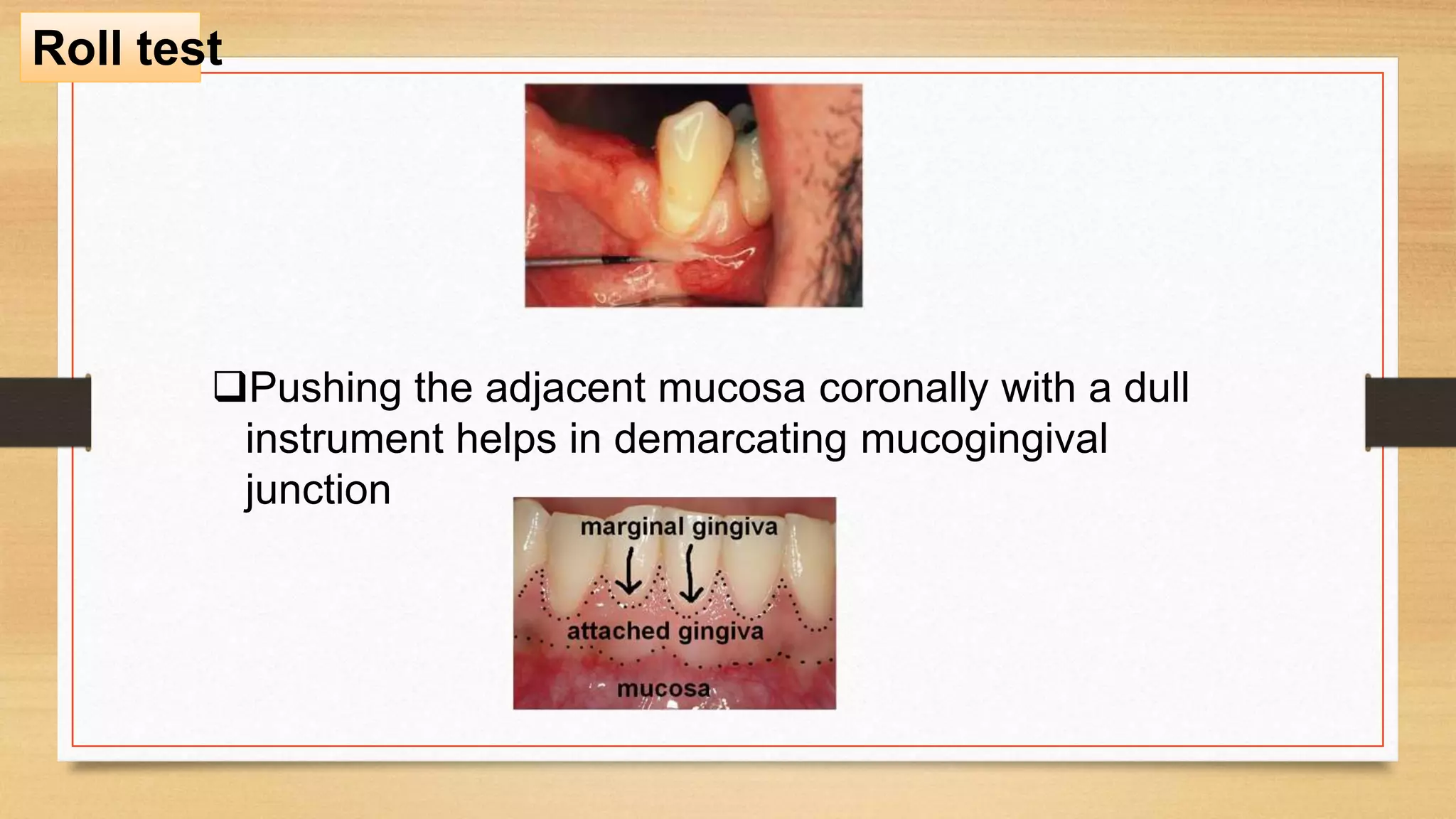 Periodontal plastic surgery | PPTX