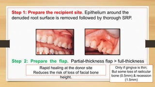 Periodontal plastic surgery | PPTX