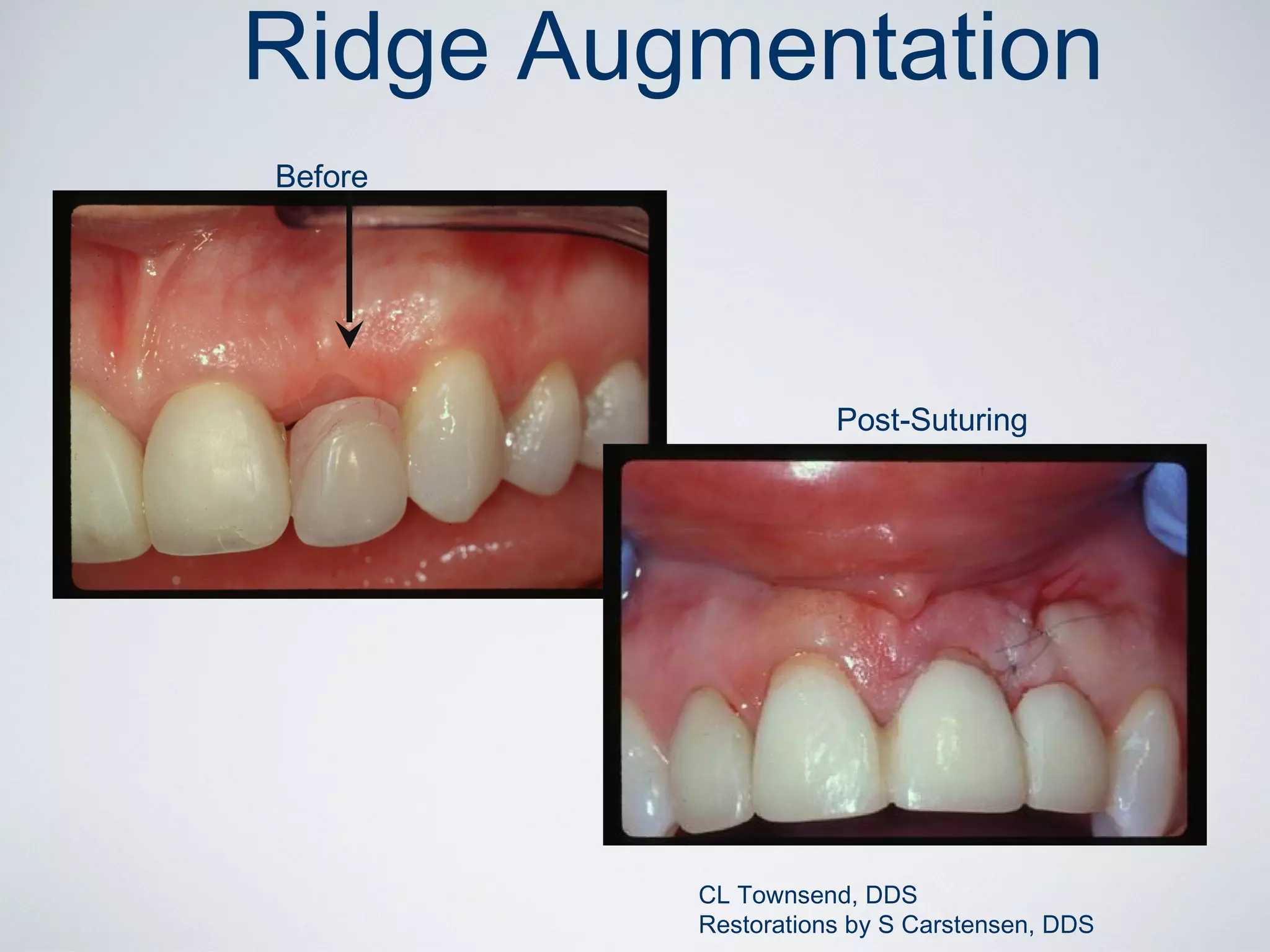 Perio plastic surgery (compressed) | PPT