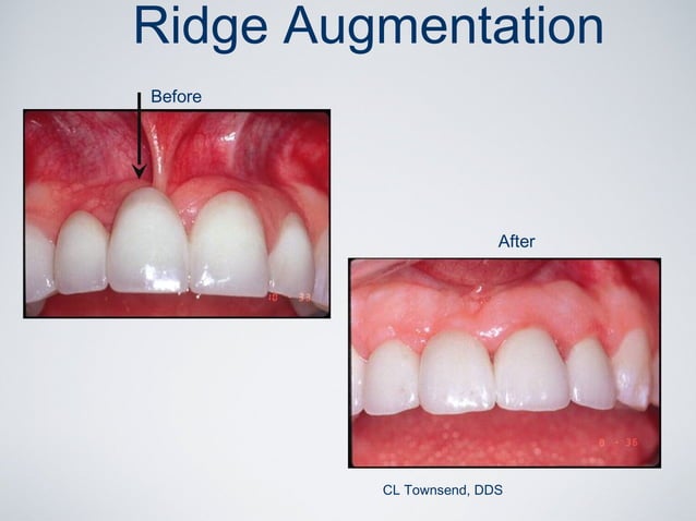 Perio plastic surgery (compressed) | PPT