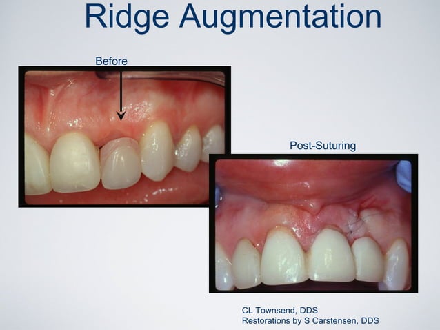 Perio plastic surgery (compressed) | PPT