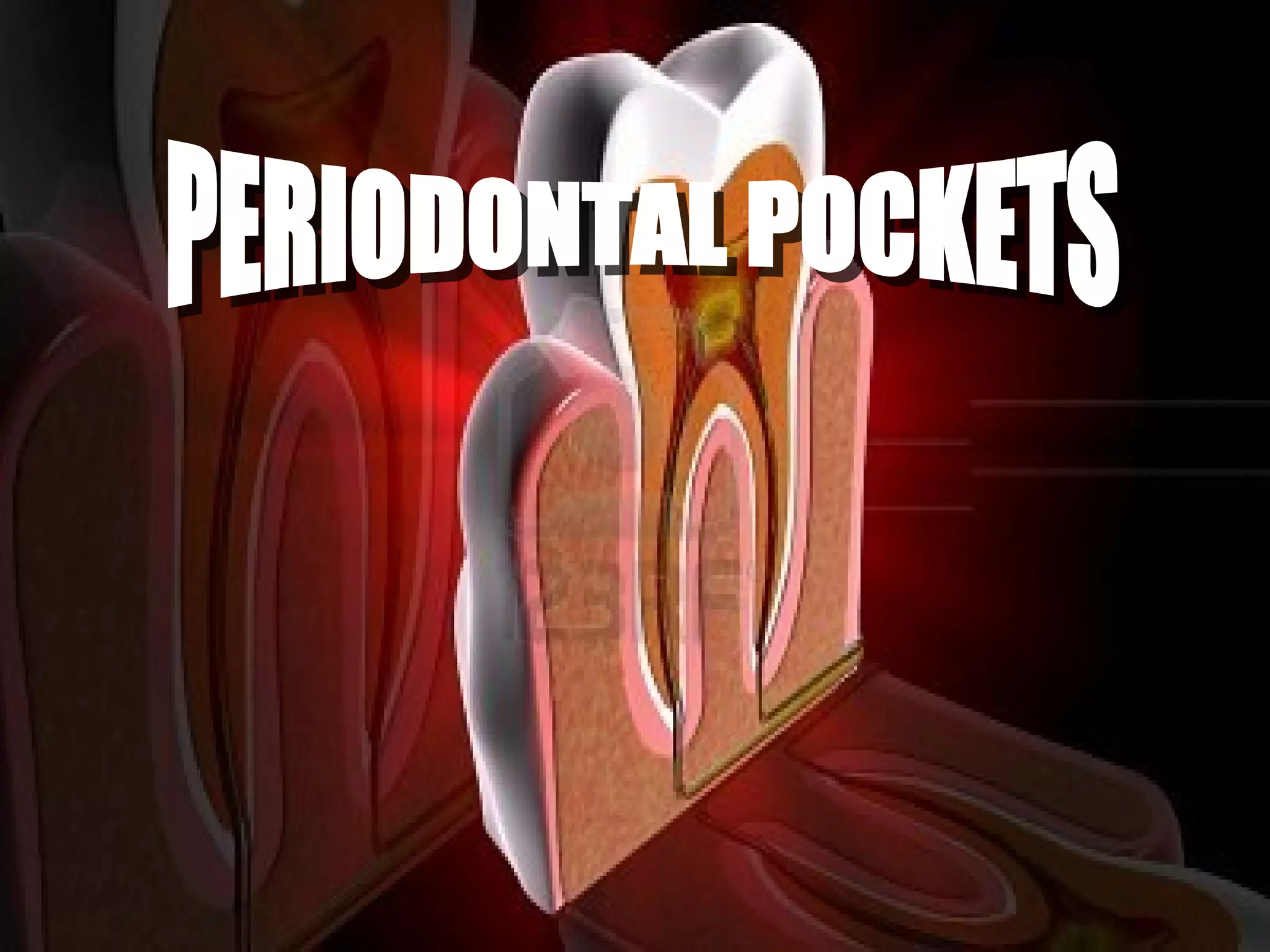 Periodontal pockets | PPT