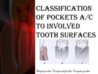 Periodontal pockets | PPT