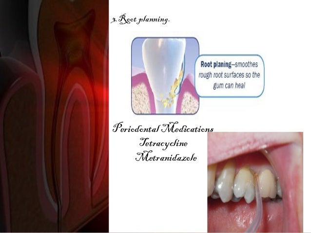 Periodontal pockets