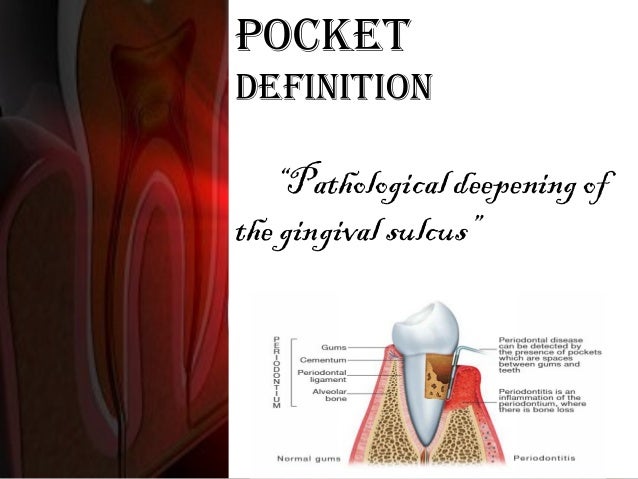 Periodontal pockets