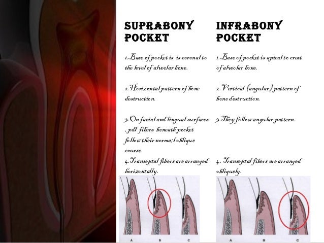 Periodontal pockets