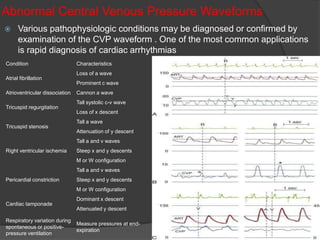 Abnormal Cvp Waveform