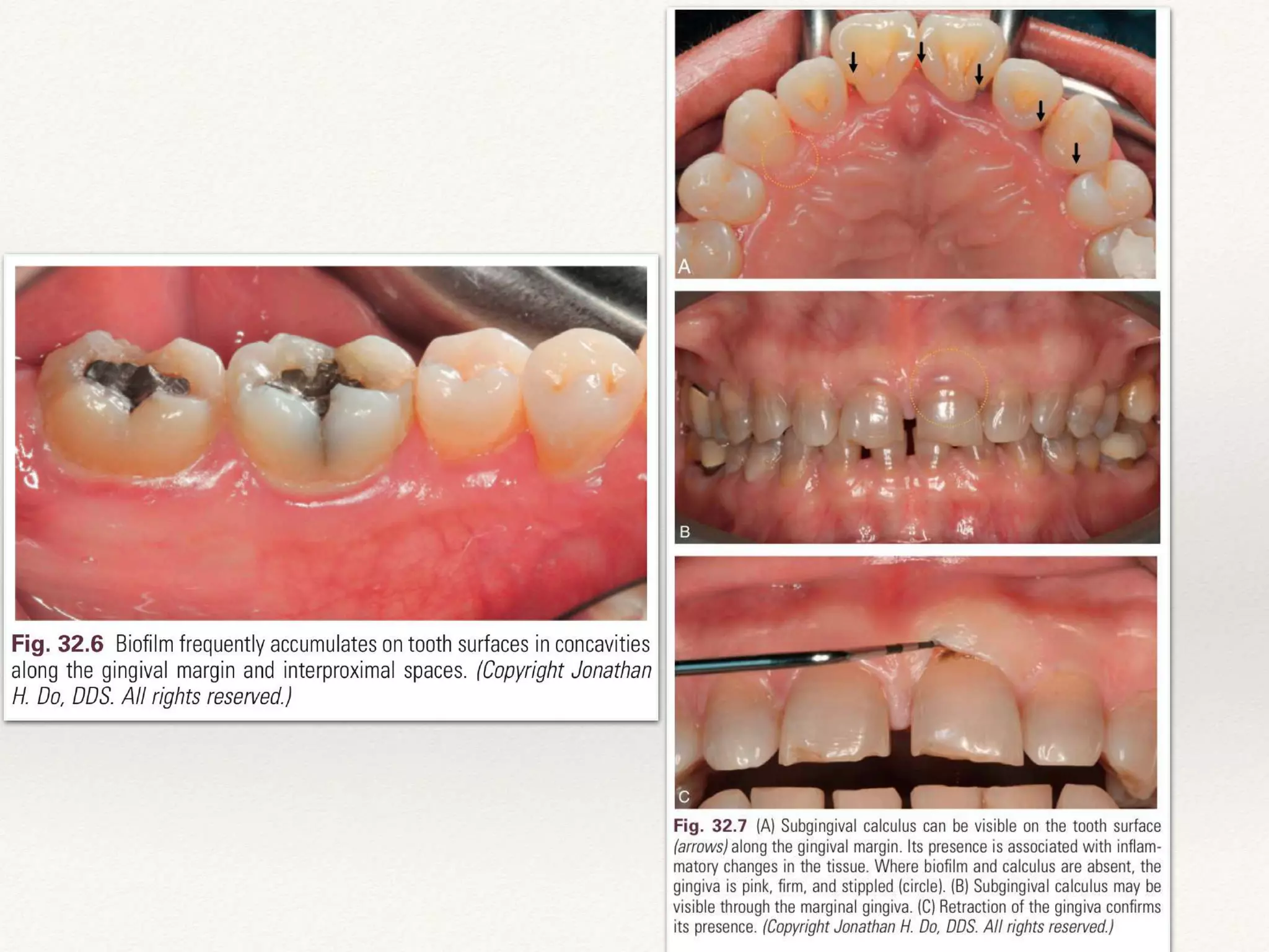 Perio presentation pdf | PPT