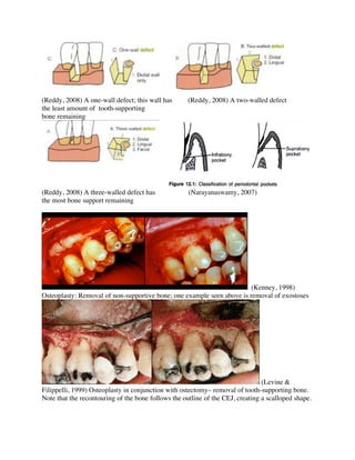 Perio Project Osseous Resective Surgery | PDF