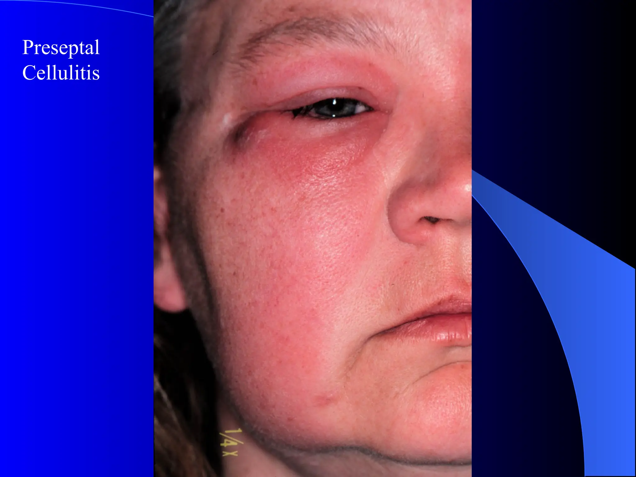 periorbital cellulitis or erythema and swelling of the eyelids.ppt ...