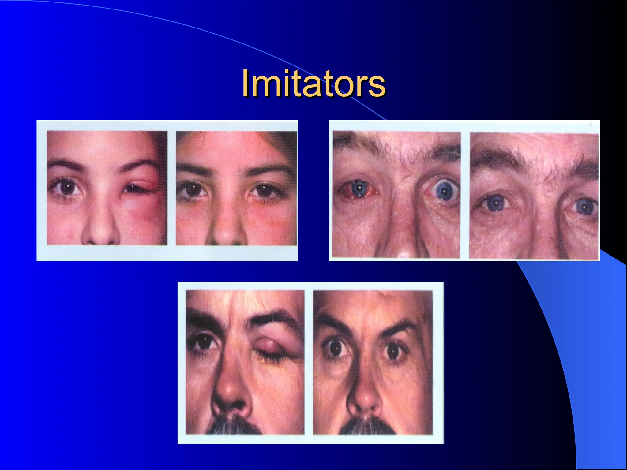 periorbital cellulitis or erythema and swelling of the eyelids.ppt