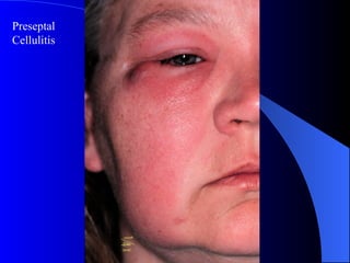 periorbital cellulitis or erythema and swelling of the eyelids.ppt