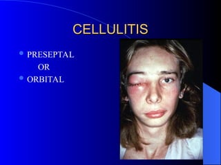 periorbital cellulitis or erythema and swelling of the eyelids.ppt