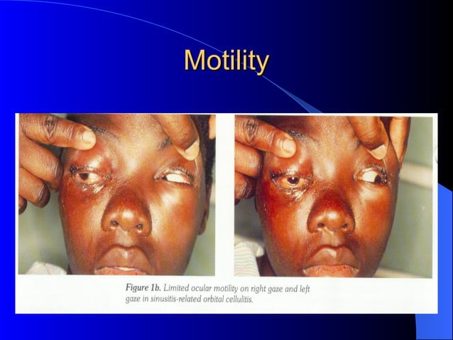 periorbital cellulitis or erythema and swelling of the eyelids.ppt ...