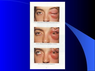 periorbital cellulitis or erythema and swelling of the eyelids.ppt
