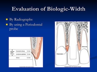 Perio restorative inter_relationship_ii__perio_ | PPT