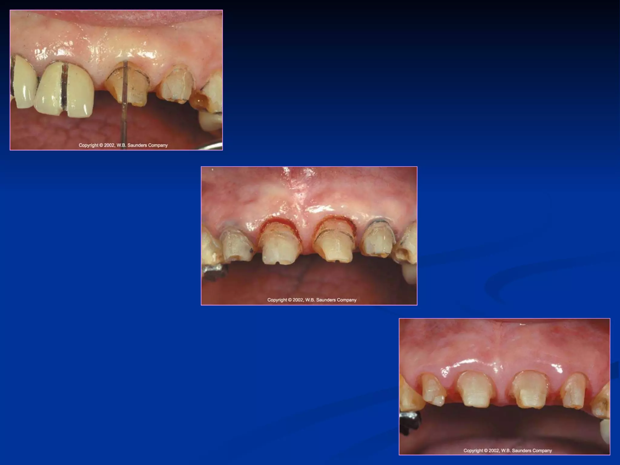 Perio restorative interelationship(periodontics) | PPT