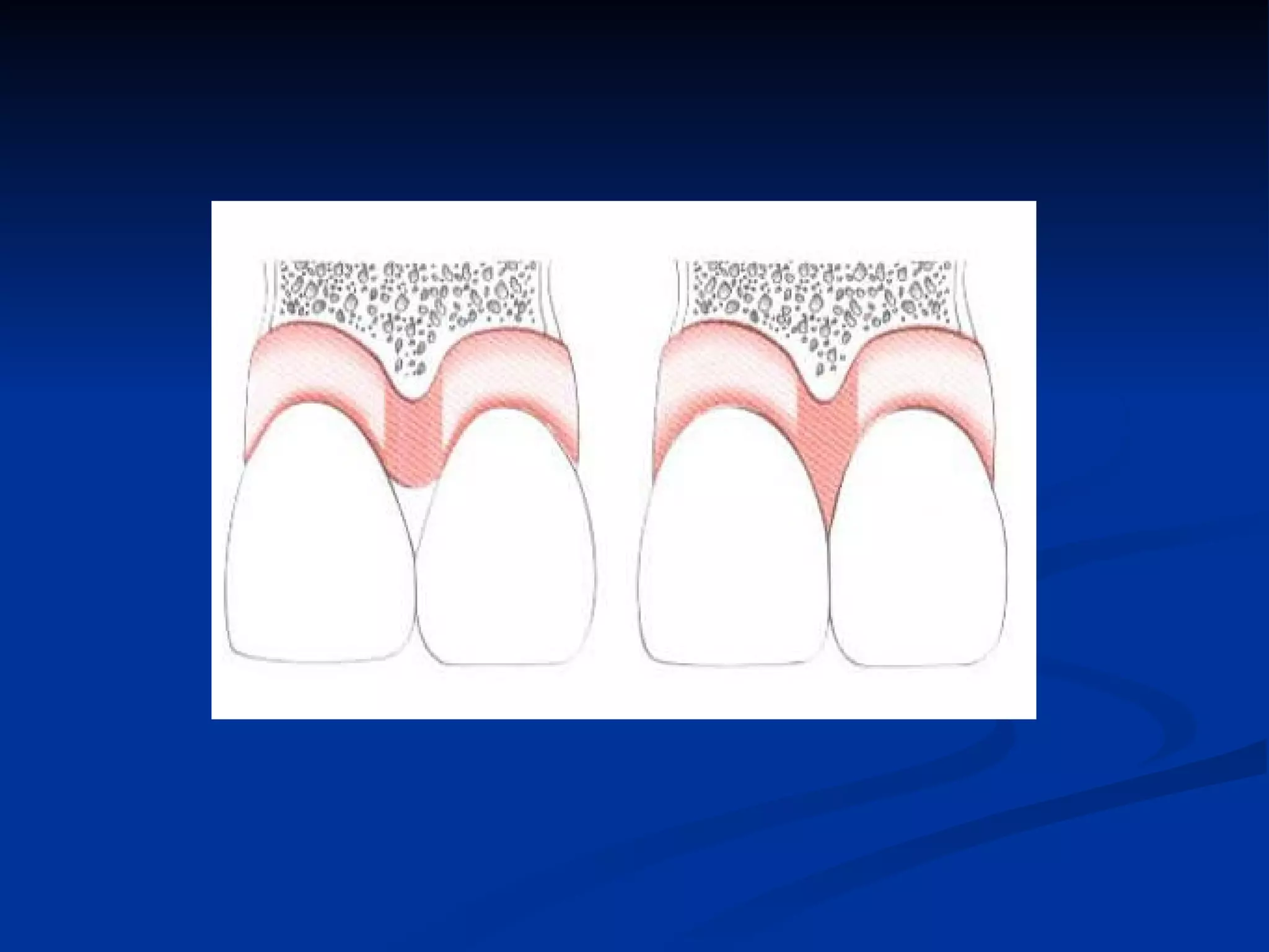 Perio restorative interelationship(periodontics) | PPT