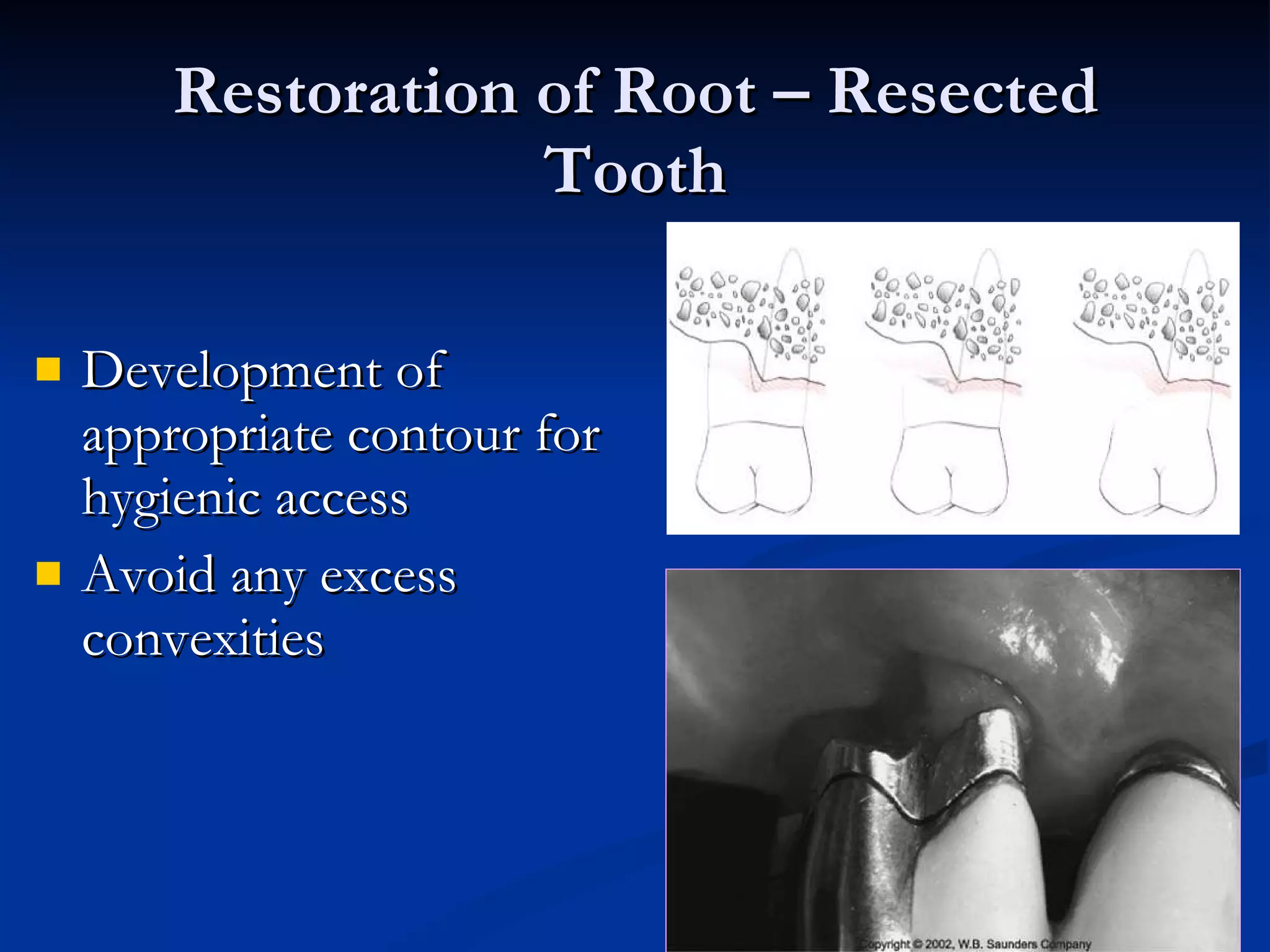 Perio restorative interelationship(periodontics) | PPT