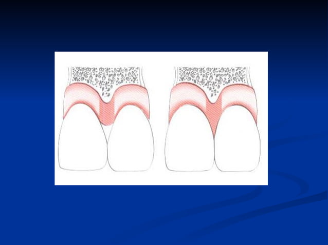 Perio restorative interelationship(periodontics) | PPT | Dental Health ...