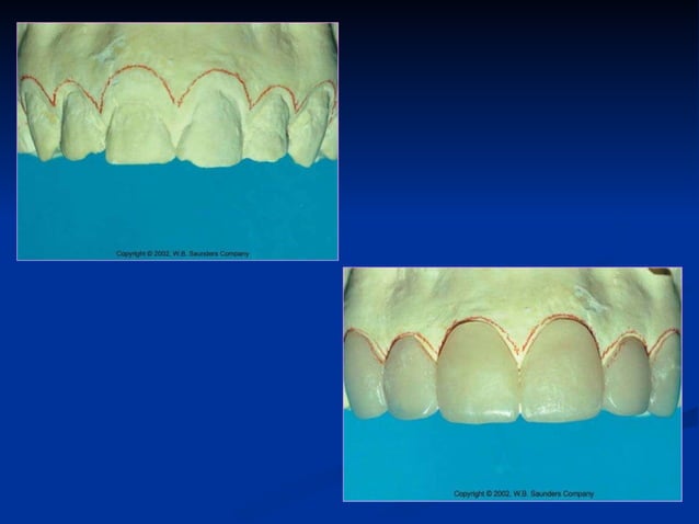 Perio restorative interelationship(periodontics) | PPT | Dental Health ...