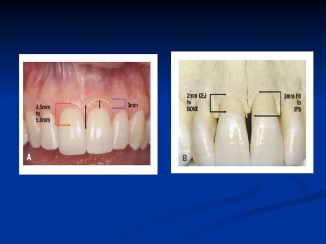 Perio restorative interelationship(periodontics) | PPT | Dental Health ...