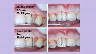 Perio restorative inter relationship lecture.pdf