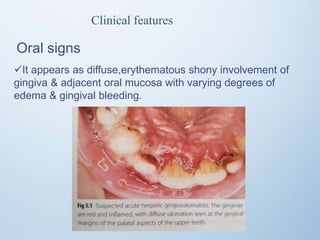 Acute gingival infections | PPT