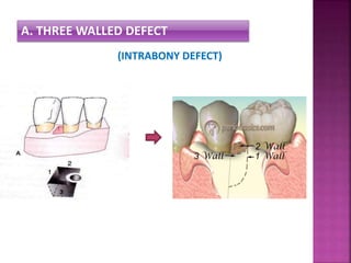 Patterns of bone destruction in periodontics | PPTX