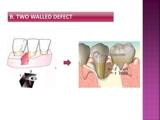 Patterns of bone destruction in periodontics | PPTX
