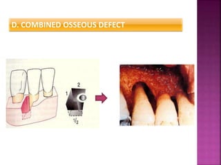 Patterns of bone destruction in periodontics | PPTX