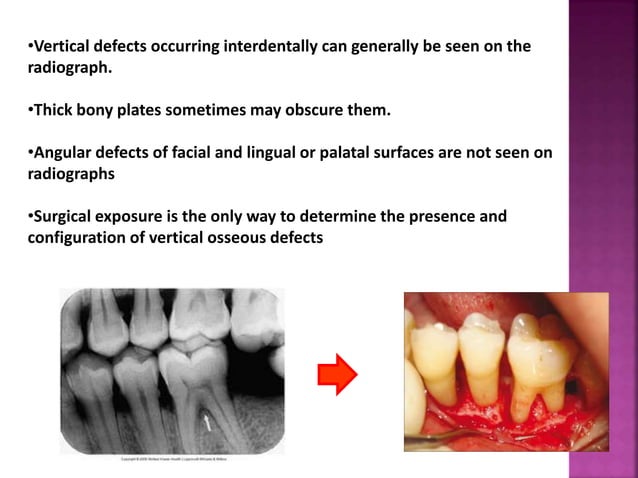 Patterns of bone destruction in periodontics | PPTX