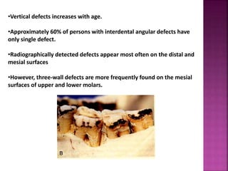 Patterns of bone destruction in periodontics | PPTX